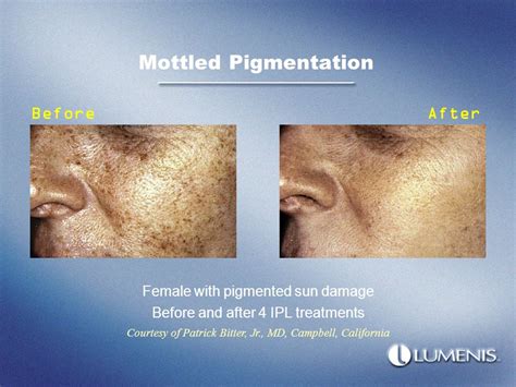Ipl™ Skin Treatments Using Photorejuvenation Ipl For Sun Damaged Skin