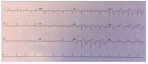 Electrocardiogram After Thrombolysis Download Scientific Diagram