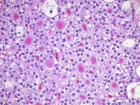 Pathology Of The Parathyroid Glands Diagnostic Histopathology