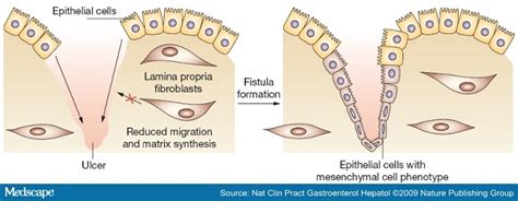 Diagnosis And Management Of Fistulizing Crohns Disease Pathogenesis