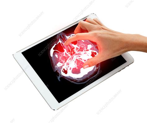 Cerebral Ct Angiogram On Tablet Conceptual Image Stock Image F0432097 Science Photo Library