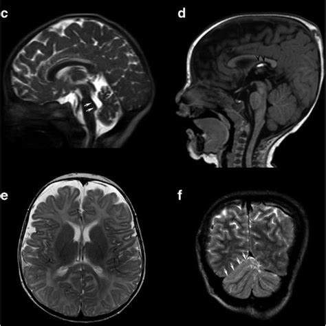 Mri Brain Abnormalities Observed Among Oavs Patients A Sagittal T1 Download Scientific Diagram