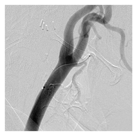 A Lateral Cervical Angiogram From The Left Common Carotid Artery