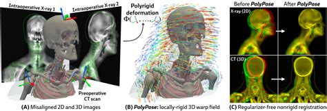 论文审查 Polypose Localizing Deformable Anatomy In 3d From Sparse 2d X