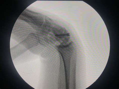 Scaphoid Proximal Pole Fracture Rradiology