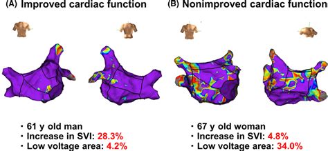 Representative Cases Of The Improved Cardiac Function Group A And The