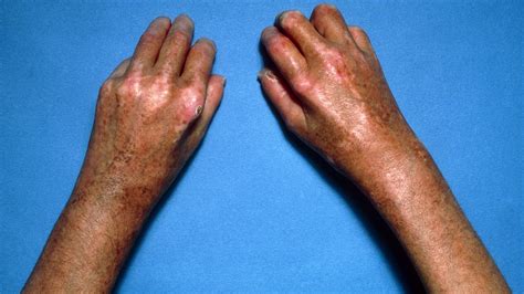 10 Diabetic Skin Problems Everyday Health