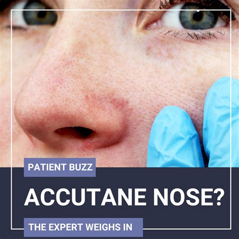 Accutane For Severe Acne Archives Next Steps In Dermatology