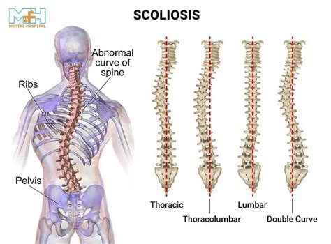 Spine Diseases Symptoms And Treatments Expert Guide