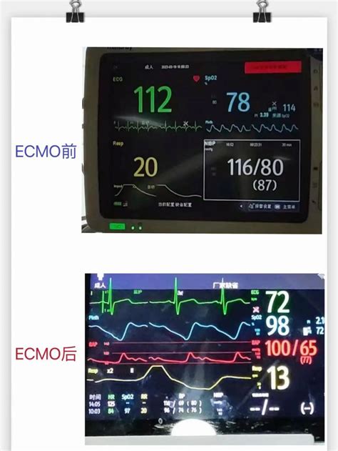 Crescent双腔·吾技无双 兰州大学第一医院成功开展西北首例双腔颈静脉插管ecmo救治危重患者 严道医声网
