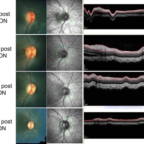 Pdf Peripapillary Retinal Nerve Fiber Layer Swelling Predicts Peripapillary Atrophy In A
