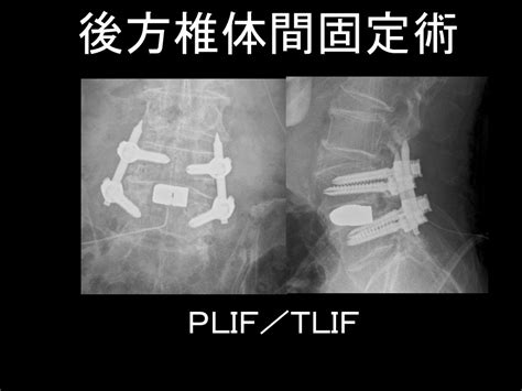 脊椎外科医が解説！l5 S1 Tlifは本当に再手術が多いのか？ ｜ 成尾整形外科病院