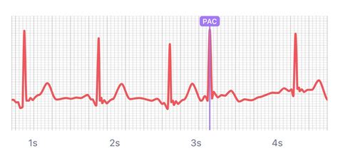Heart Fluttering Causes Checks And When To Seek Help Qaly