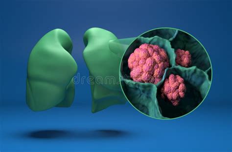 Lung Cancer Lc Stock Illustration Illustration Of Immune 344441283