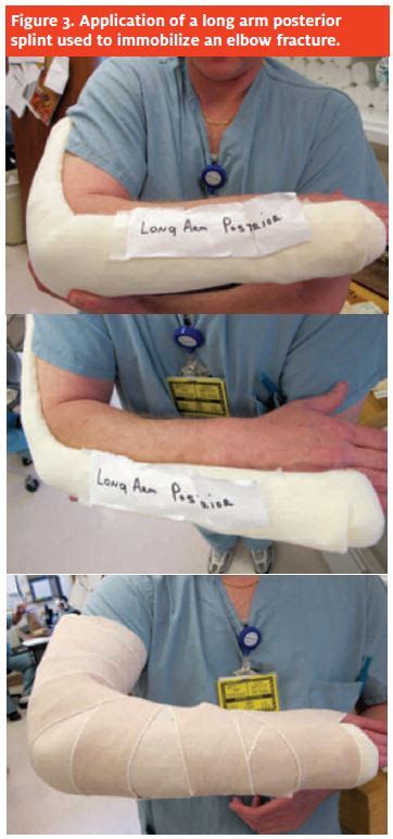 Posterior Elbow Splint