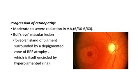 Ocular Side Effects Of Medicines Pptx