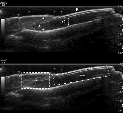 Nail Enthesis Ultrasound In Psoriasis And Psoriatic Arthritis A Report