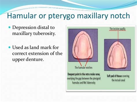 Hamular Notch Anatomy For Complete And Partial Dentures Ppt Download