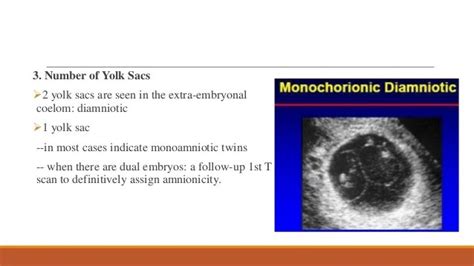 Lambda And T Sign In Twin Pregnancy Twin Peak Sign Or Lambda Sign