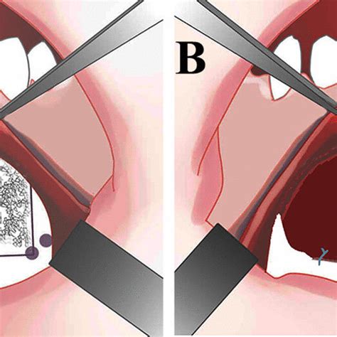 Schematic Diagram Of The Periosteum Covered Periodontally Accelerated Download Scientific
