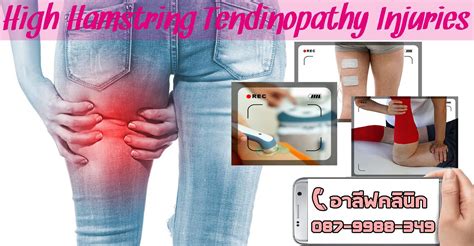 High Hamstring Tendinopathy อาลีฟคลินิคกายภาพบำบัด