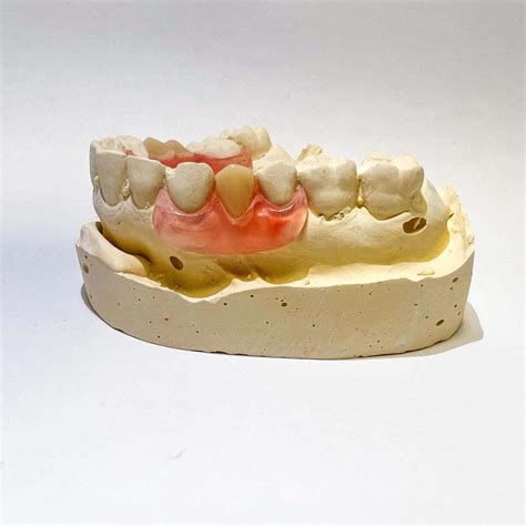 Affordable Unilateral Partial Denture Restore Your Smile