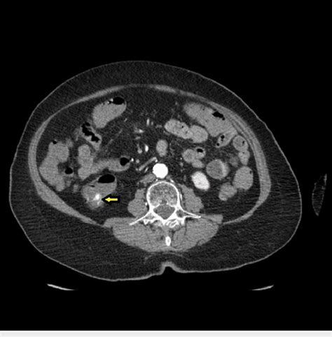 Ct Of The Abdomen Showing Active Bleeding In The Proximal Ascending Download Scientific Diagram