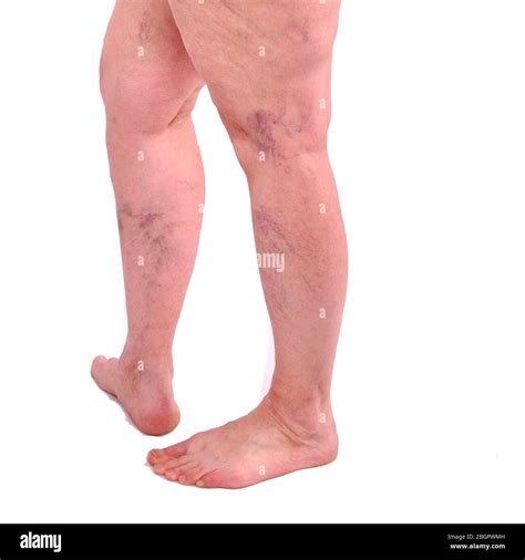 Vascular Calves