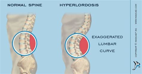 Lumbar Hyperlordosis Smit Medimed Pvt Ltd