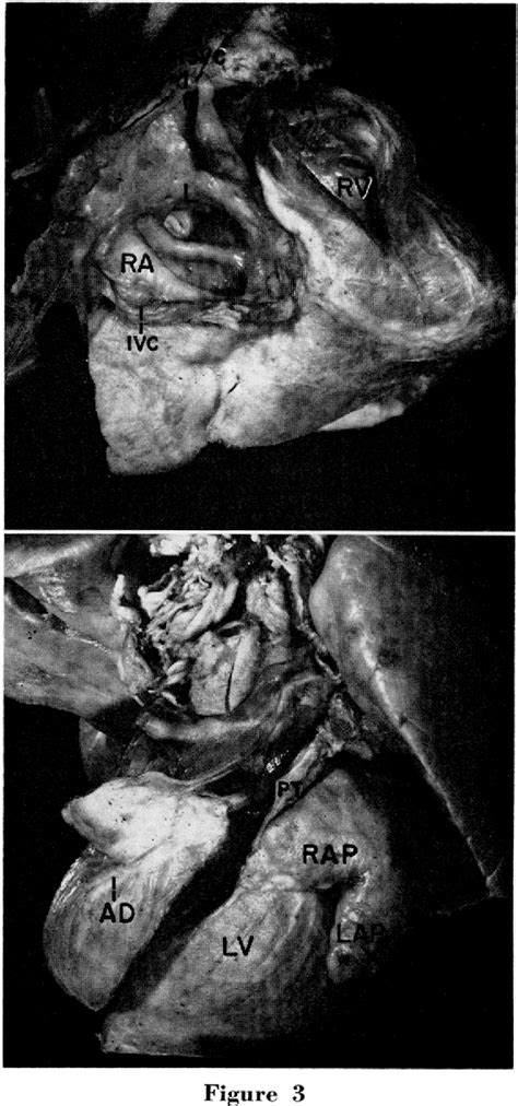 Figure 3 From Pathologic Anatomy Of Dextrocardia And Its Clinical
