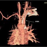Four Branches Arises From The Aortic Arch Aberrant Right Subclavian