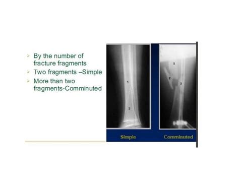 Interpretation Of Musculoskeletal X Rays Pptx