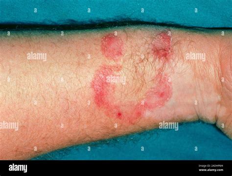 Tinea Close Up Of The Wrist Of A Patient Affected By Tinea A Fungal Infection Of The Skin