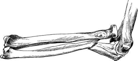 Fractured Ulna With Dislocation Of Radius Vintage Illustration