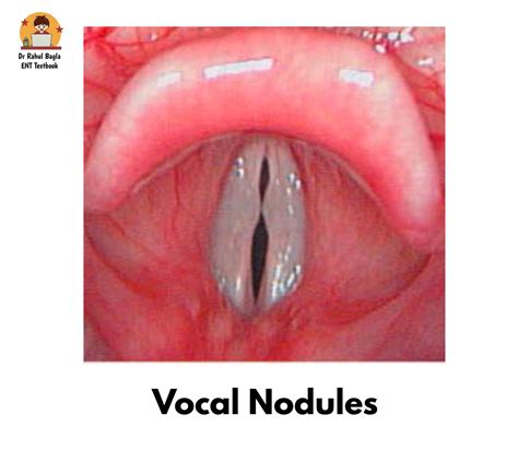 Benign Tumours Of The Larynx Recurrent Respiratory Papillomatosis
