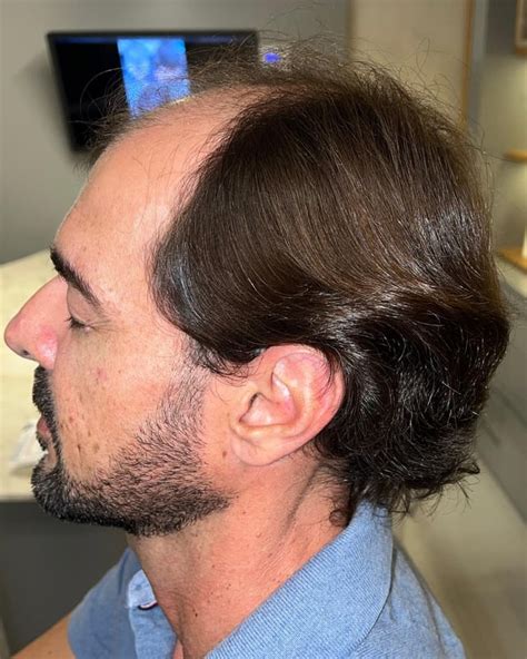 My Update Up To 7 Months Dr Pittella Rhairtransplants