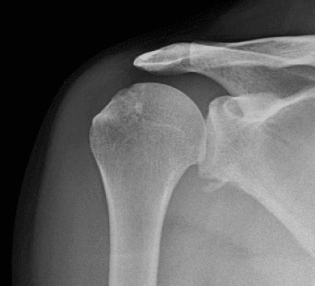 Shoulder Injuries Approach And Dislocations Emergency Medicine Cases