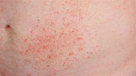 Rash On Side Of Torso