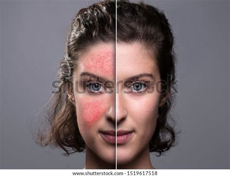 4 Topic Dermatitis Before After 图片、库存照片、3d 物体和矢量图 Shutterstock