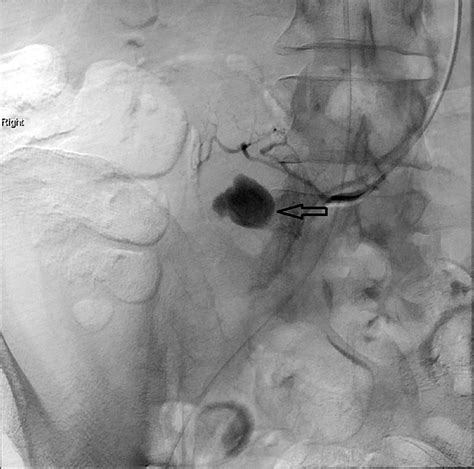 Selective Sma Angiogram Confirmed A Right Iliac Fossa Pseudoaneurysm Download Scientific