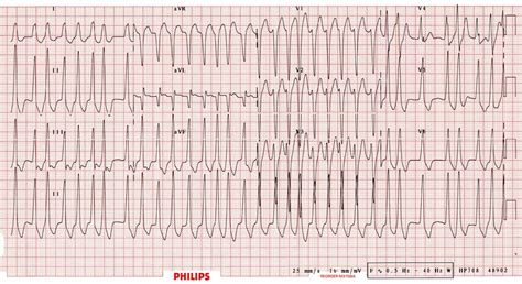 Atrial Fibrillation With Wpw Emergency Medicine Cases