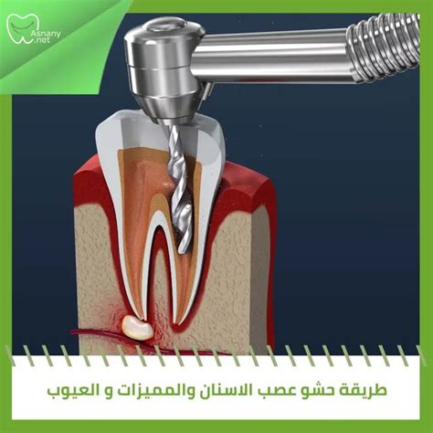علاج تسوس جذور الاسنان مدونة أسنانىنت