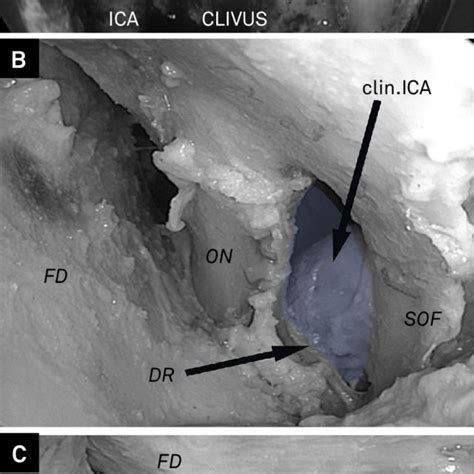A Intraoperative Image Of A Well Pneumatized Optic Strut B