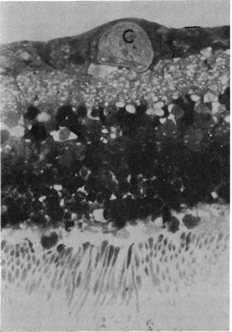 Case I Electron Micrograph Of Arterial Embolus Observed In Inferonasal Download Scientific