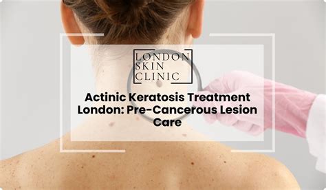 Actinic Keratosis Treatment London