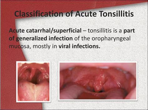 Acute Tonsillitis Nhg Keelklachten Bij Kinderen Btmpsp