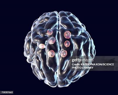 Brain Lesions Photos And Premium High Res Pictures Getty Images