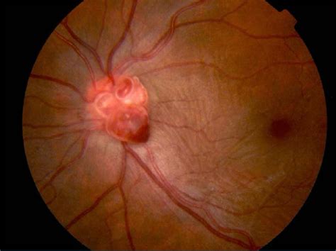 A Color Fundus Retinography Of The Left Eye On Day 30 After Ppv An
