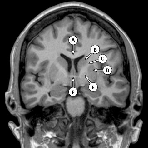 Internal Capsule Mri Brain Anatomy 630x630