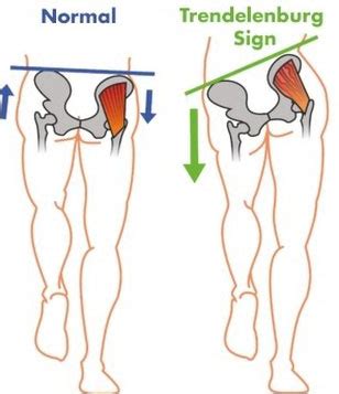 Gluteal Tendinopathy Sydney Cbd Physiotherapy